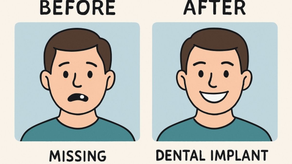 How Dental Implants Are Changing Everyday Lives